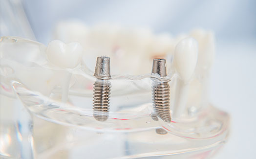 Dental Implants in Woodbridge | Roysun Dental Centre