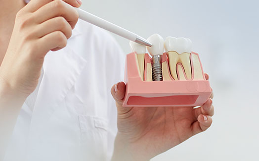 Dental Implants in Woodbridge | Roysun Dental Centre